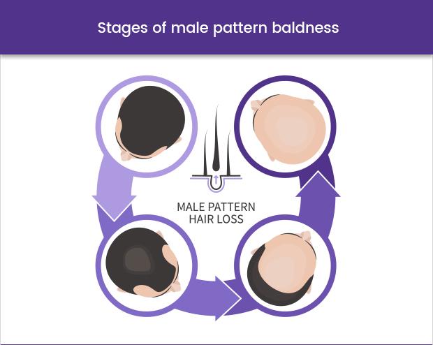 ᐅ Buy Male Pattern Baldness Treatments Online Free Shipping